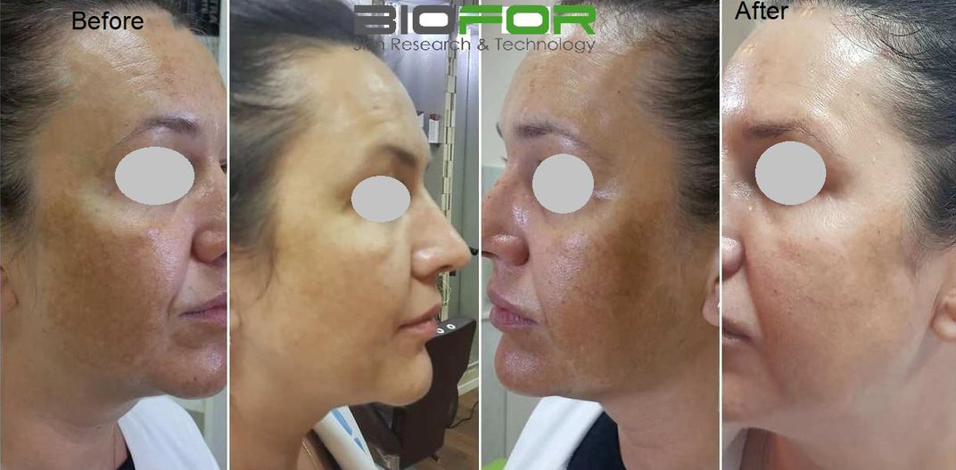 How to Get Stronger Melanin Suppression? - Biofor